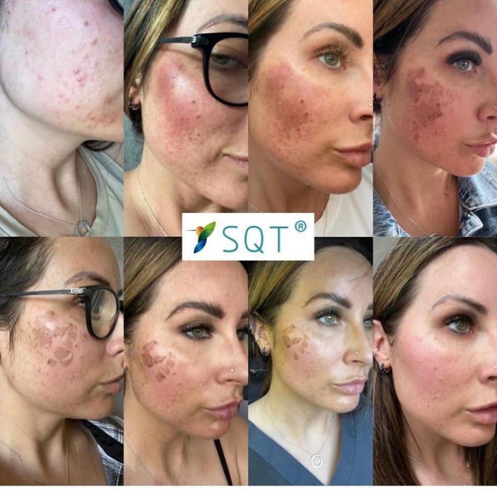 Makyas - SQT® Bioneedling