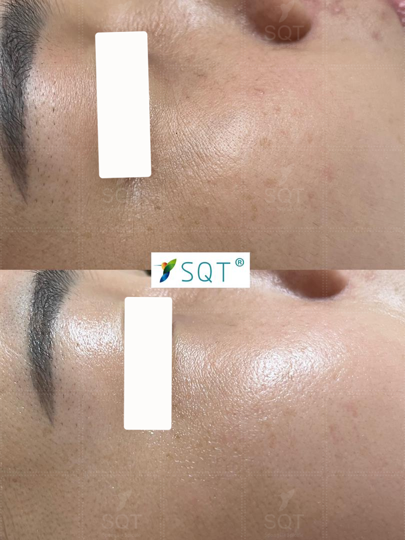 Makyas - SQT® Bioneedling